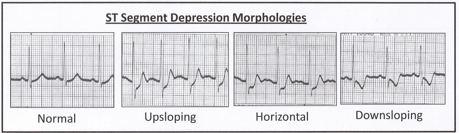 Abnormales EKG: Auffälligkeiten, Bedeutung und Ursachen
