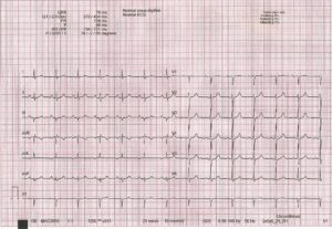 Normales EKG lesen: Bilder, Kurven und Werte