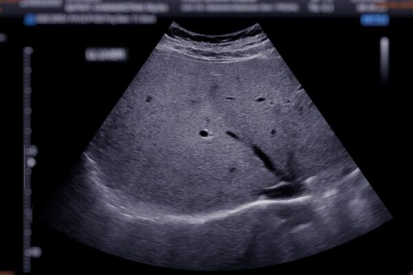 Der CW-Doppler-Ultraschall (Continuous-Wave-Doppler)