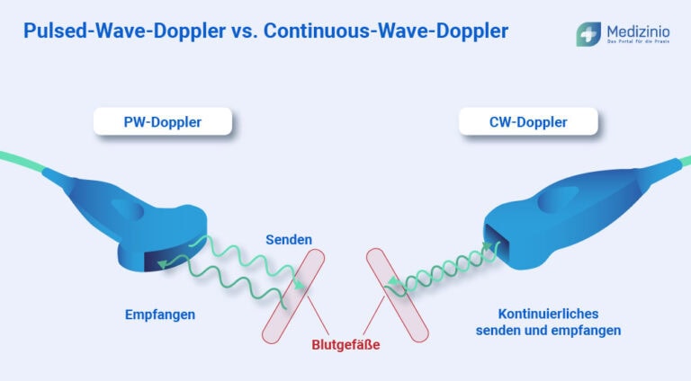 PW-Doppler (Pulsed-Wave Doppler, gepulster Doppler)