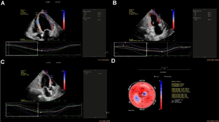 Der CW-Doppler-Ultraschall (Continuous-Wave-Doppler)