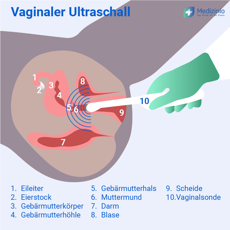 op durch die scheide