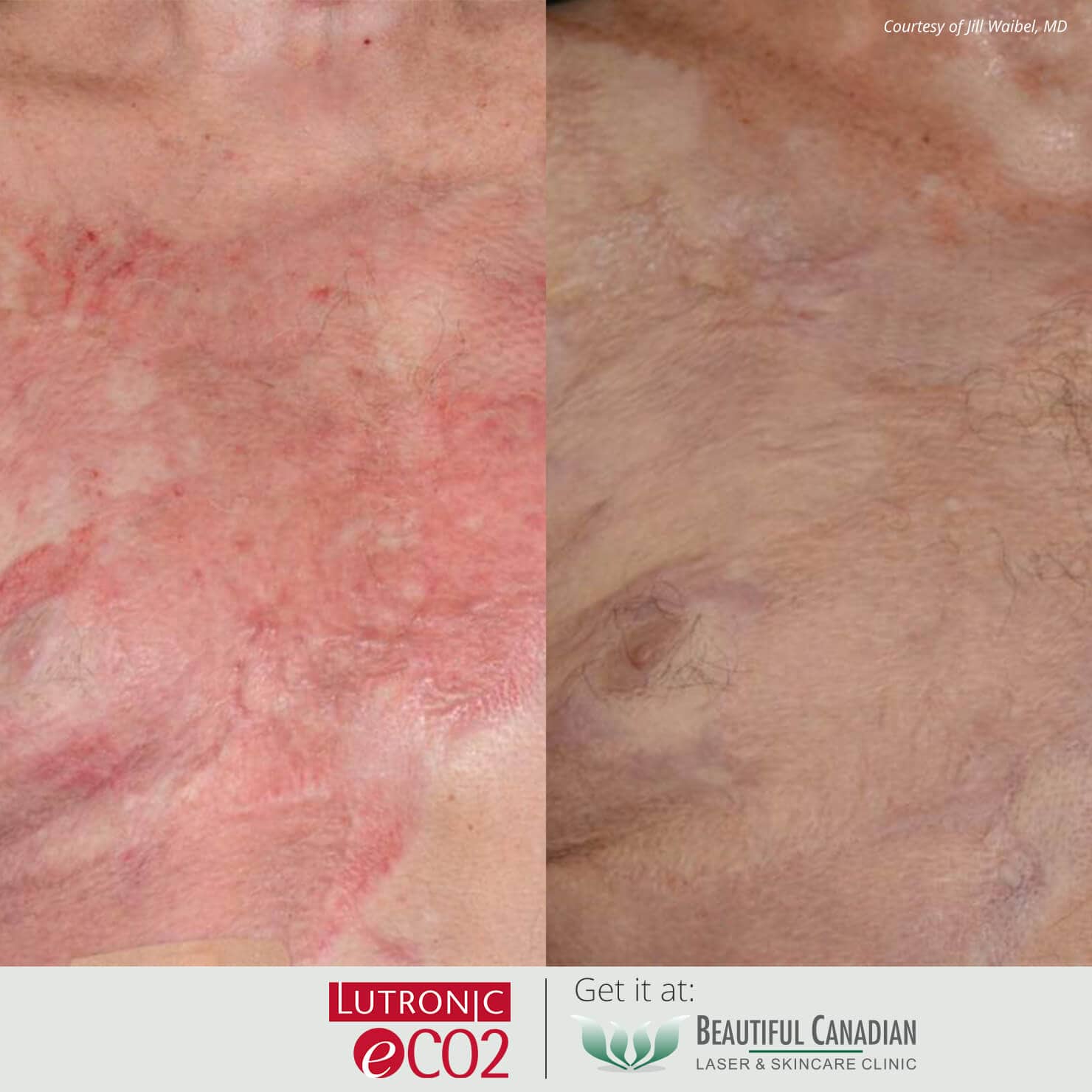 Vancouver Fractional CO2 Laser | Skin Resurfacing Surrey, Delta, Langley