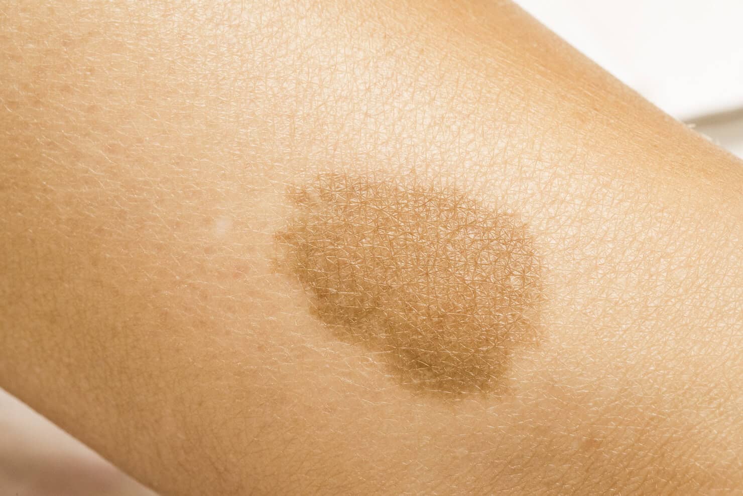 Vancouver Hyperpigmentation Treatments w/ Lasers & More in Surrey ...