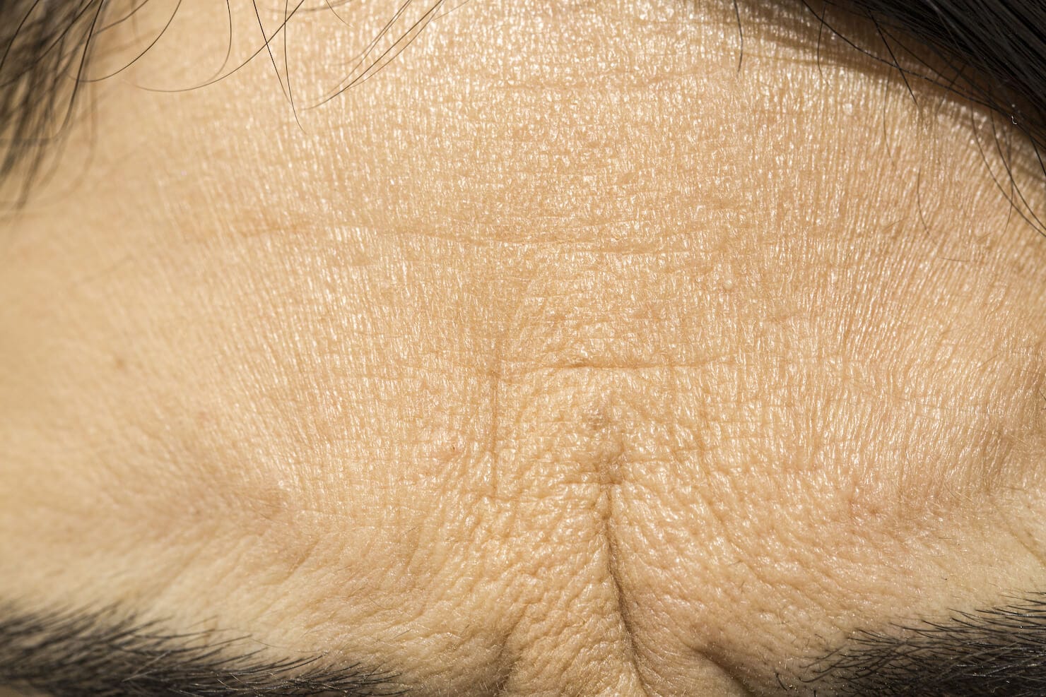 Surrey Forehead Wrinkle Treatments | How to Get Rid of Forehead Wrinkles