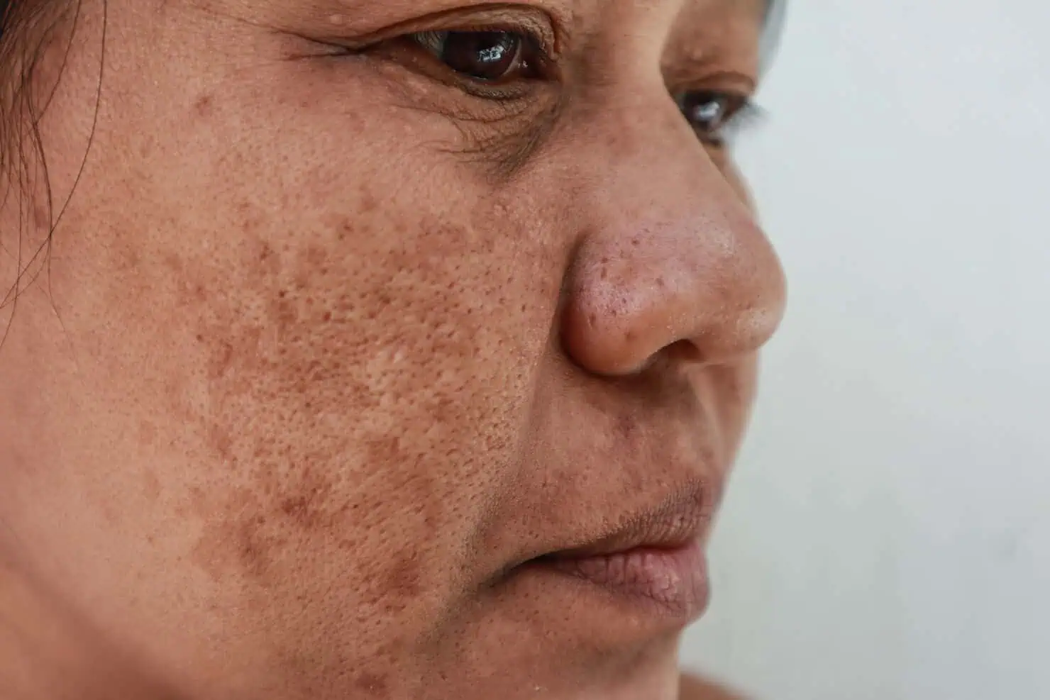 Vancouver Hyperpigmentation Treatments w/ Lasers & More in Surrey ...