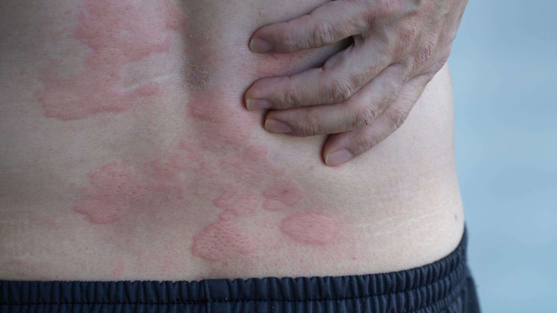 TLR7/8 Inhibitor Shows Safety & Efficacy in Cutaneous Lupus ...