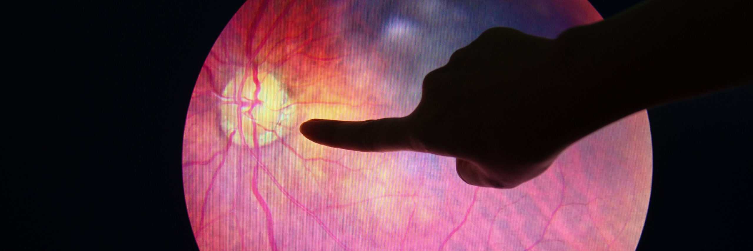 Purtscher-like retinopathy in a 19-year-old with maturity-onset ...