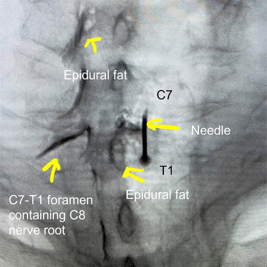 interlaminar epidural