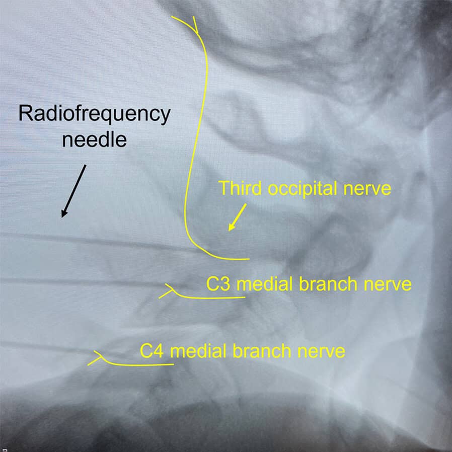cervical branch blocks