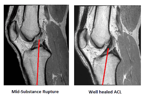torn acl mri