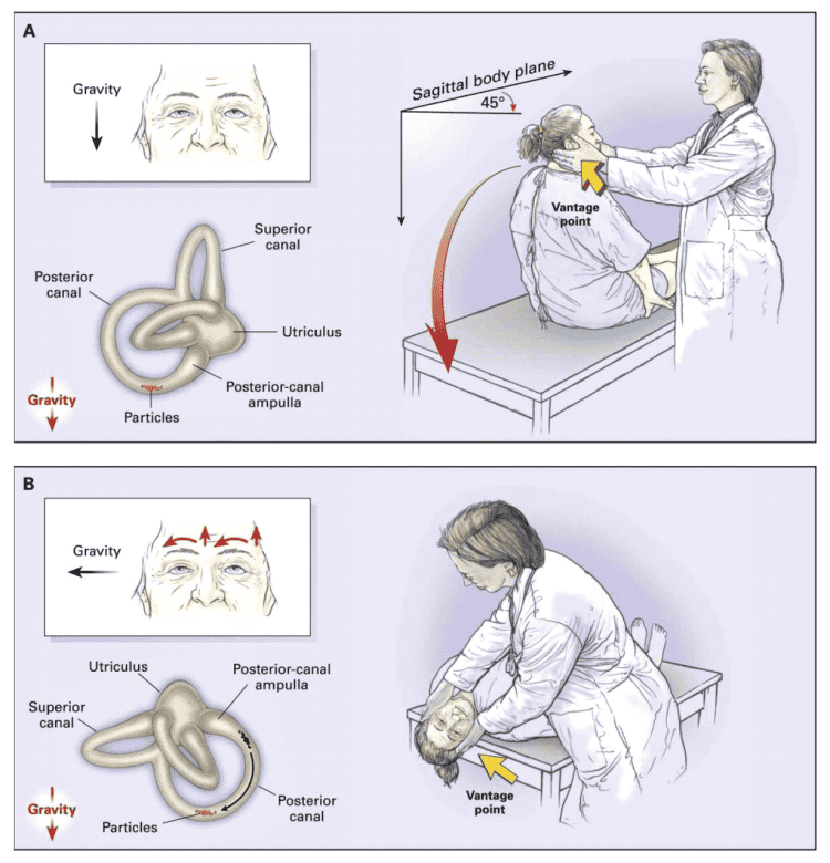 vertigo head shaking