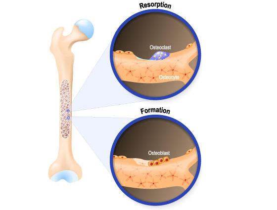 What is a Bone Stress Injury? | Blog