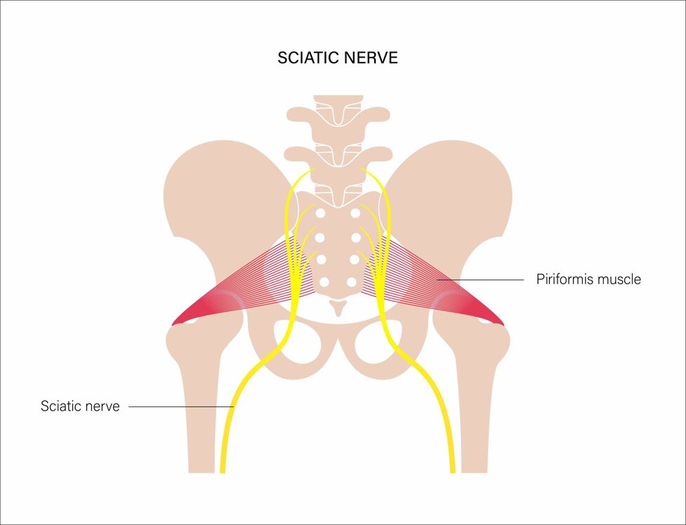 centralization sciatica