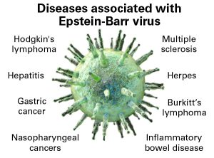 Epstein-Barr Virus (EBV): Symptoms & Natural Treatment Options