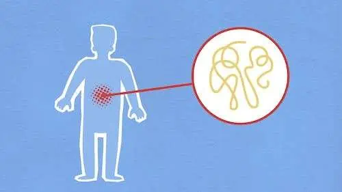 What Is CIRS? Explore Chronic Inflammatory Response Syndrome