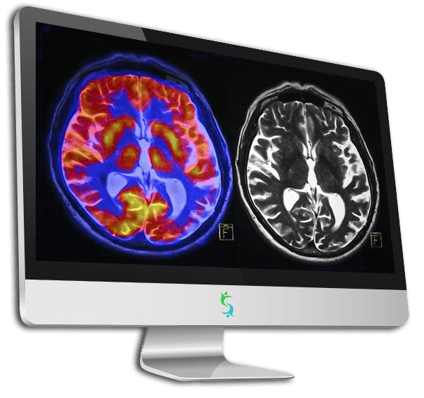 Pet Scan Brain: Uncovering Your Brain's Electrical Activity