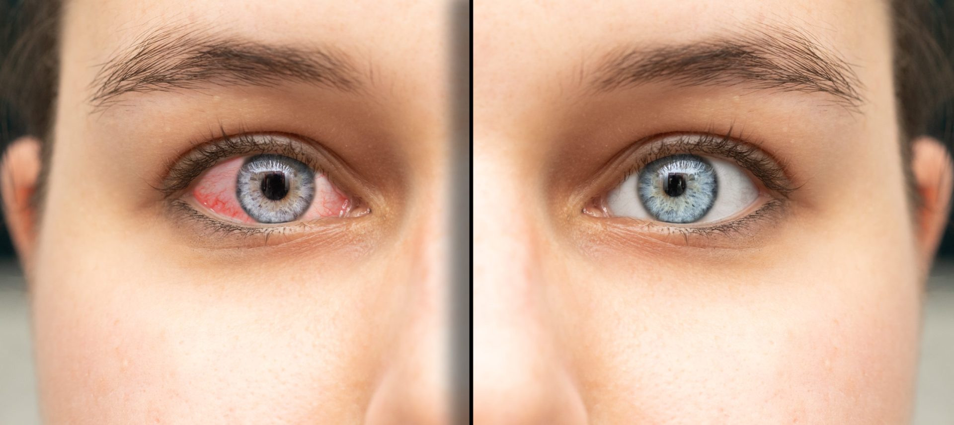 Can Mold Exposure Cause Pink Eye?
