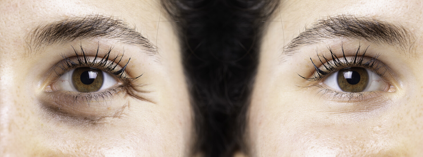 Surrey Eye Circles & Bags Treatments | Delta & Langley Eye Treatments