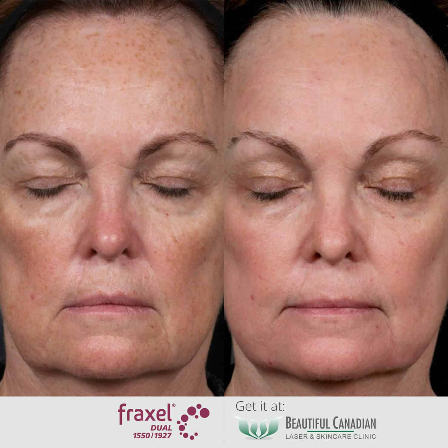 Vancouver Fraxel® DUAL Laser (in Surrey) | Skin Tone & Anti-Aging ...