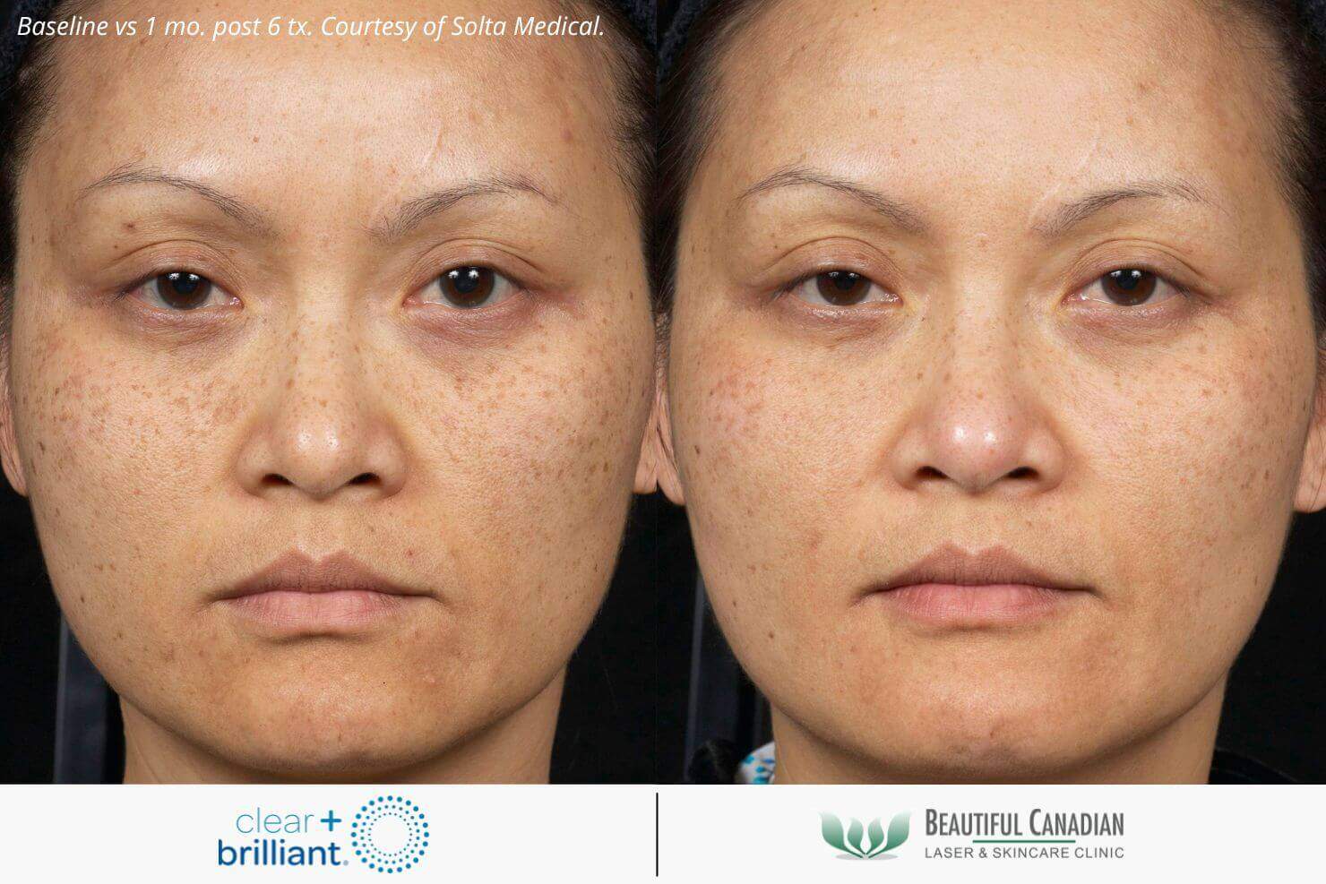 Clear + Brilliant® Laser Skin Rejuvenation Vancouver (Surrey)