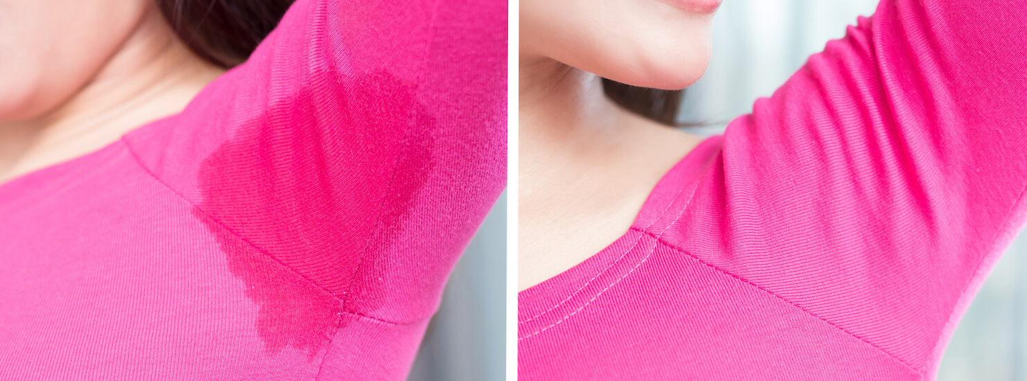 Treat excessive sweating & hyperhidrosis in Surrey, B.C. (Metro Vancouver)