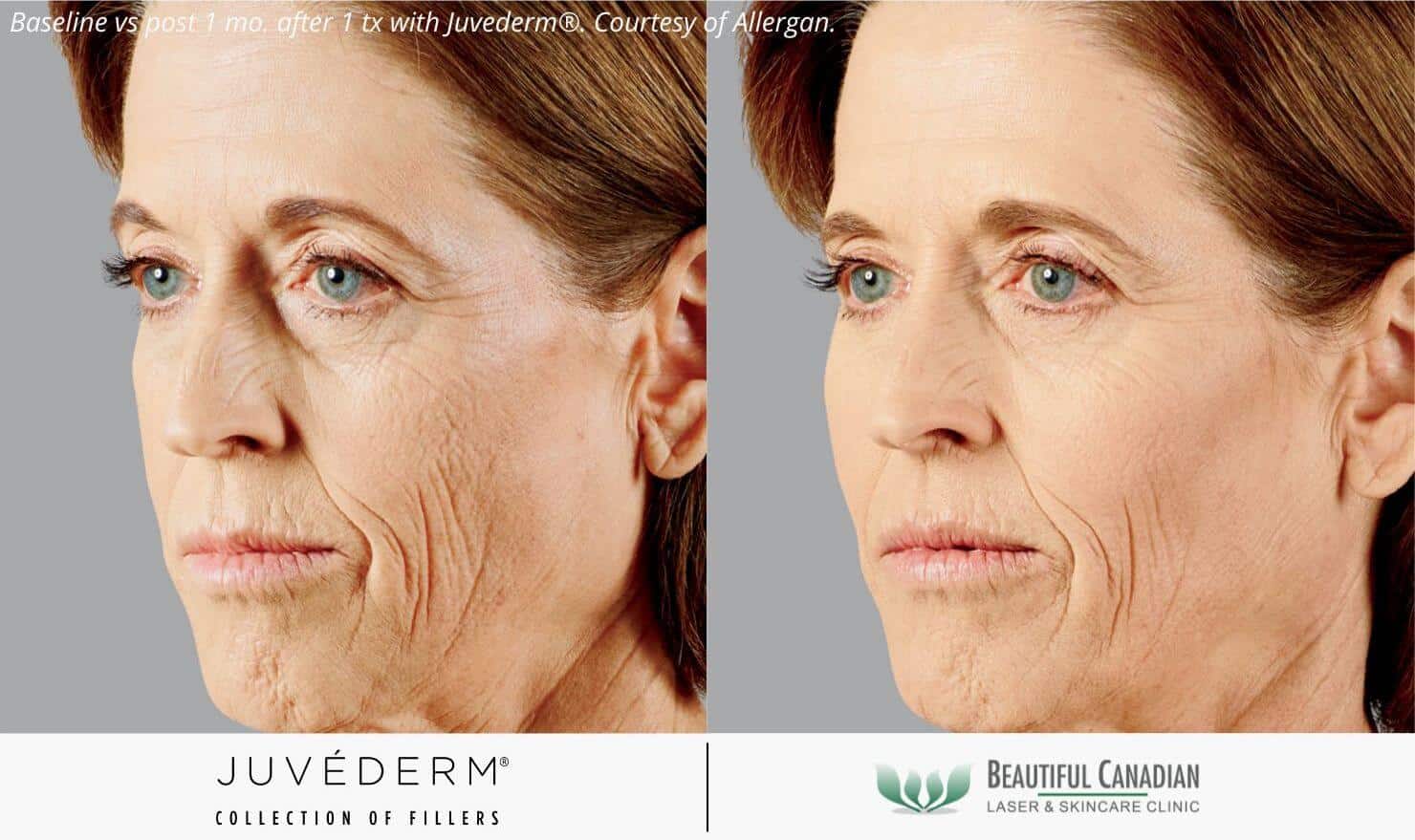 Juvéderm® Vancouver | Juvéderm® Surrey, White Rock, Langley, Delta | Doctor-Led Dermal Injections