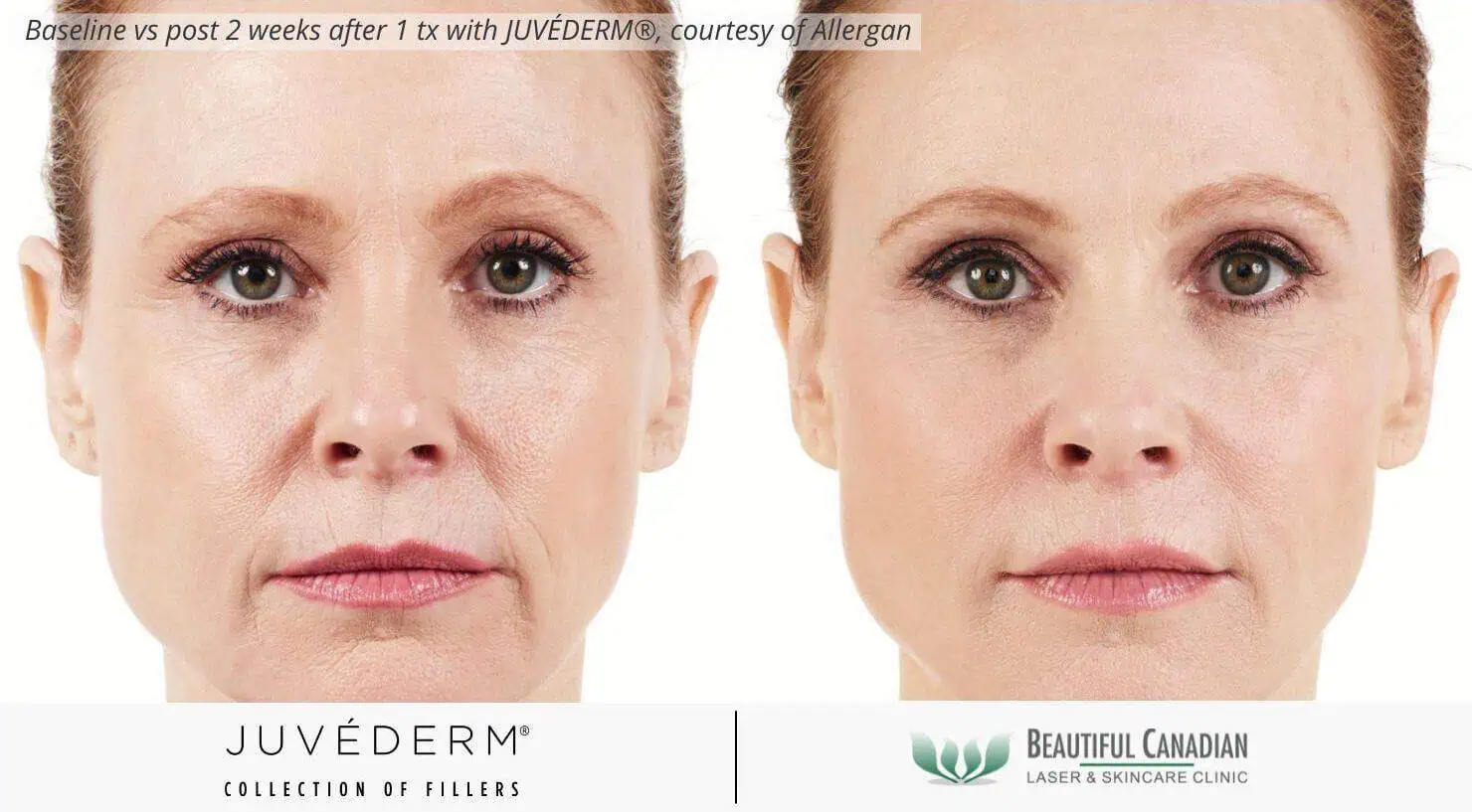 Top Surrey Dermal Fillers | Wrinkle Relaxers | Facial Fillers Vancouver