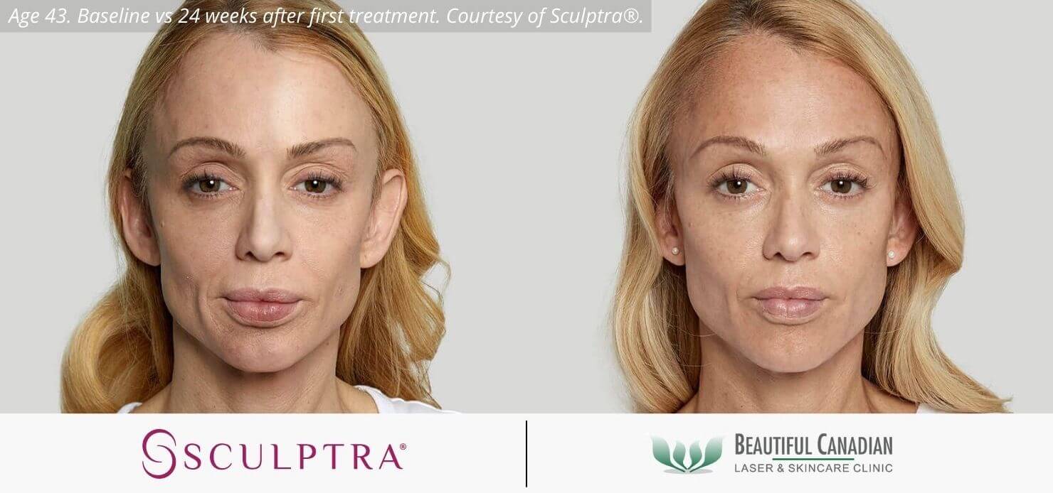 Vancouver Sculptra® Aesthetic for Non-Invasive Face Lifts (in Surrey ...