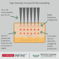 Vancouver Infini™ RF Microneedling (Surrey) | Collagen Induction ...