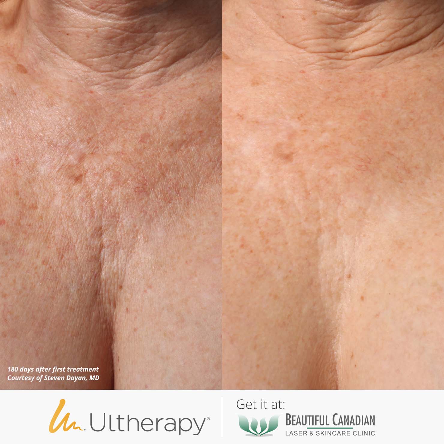 Vancouver Ultherapy® | Skin tightening in Surrey | BC Laser and ...