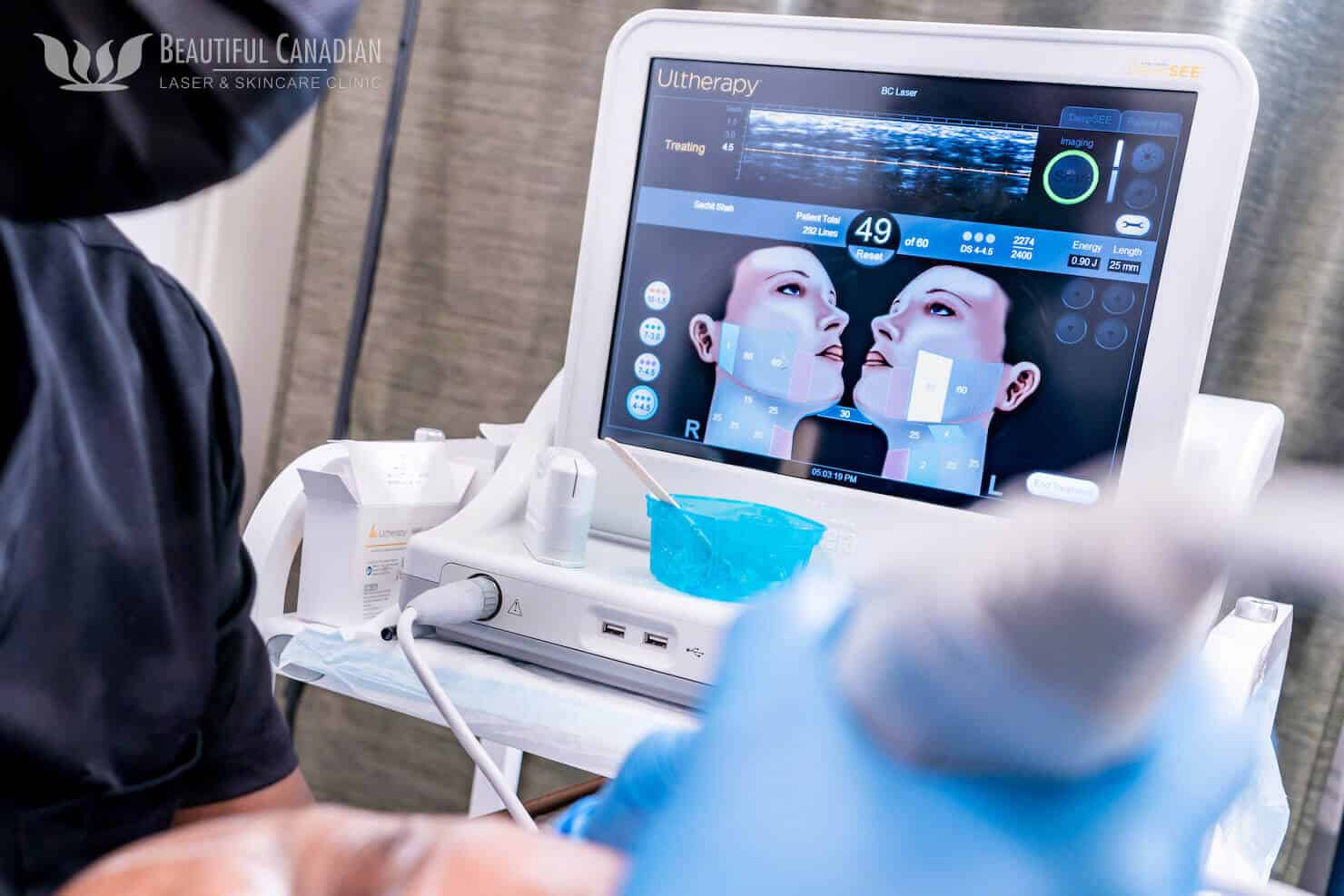 Vancouver Ultherapy® | Skin tightening in Surrey | BC Laser and ...