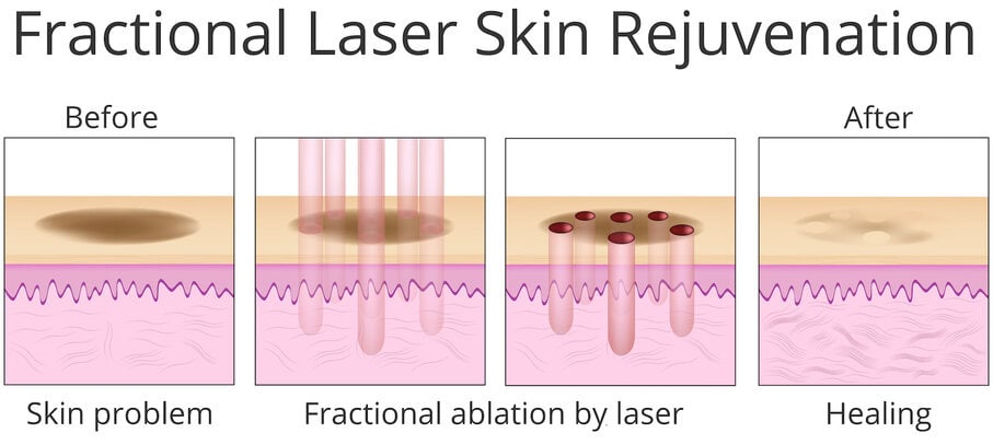 Co2 Laser Diagram