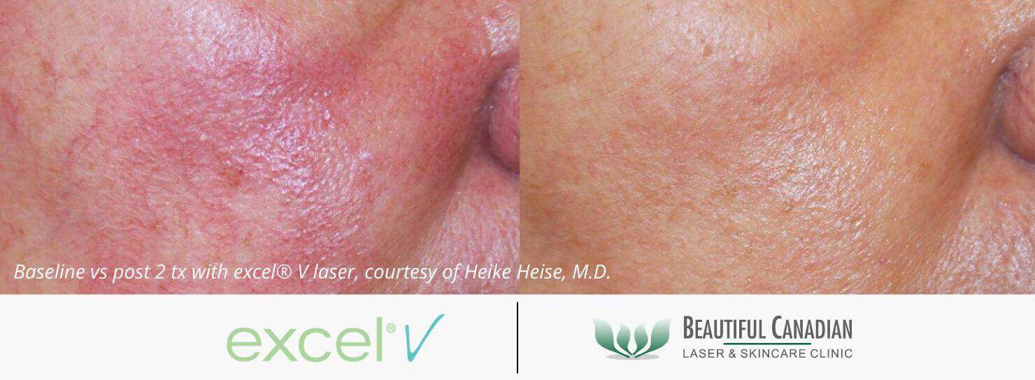 excel® V laser for getting rid of redness, discolouration and ...