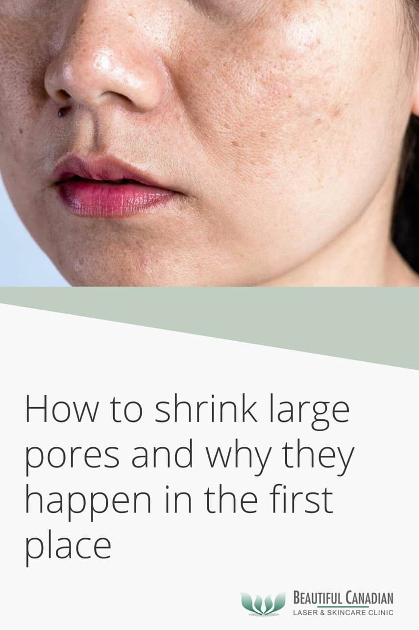 Large Pores On Cheeks Causes