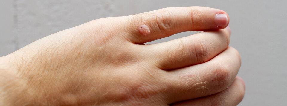 Wart Removal Before And After Pictures Of Wart Removal — MOYAL